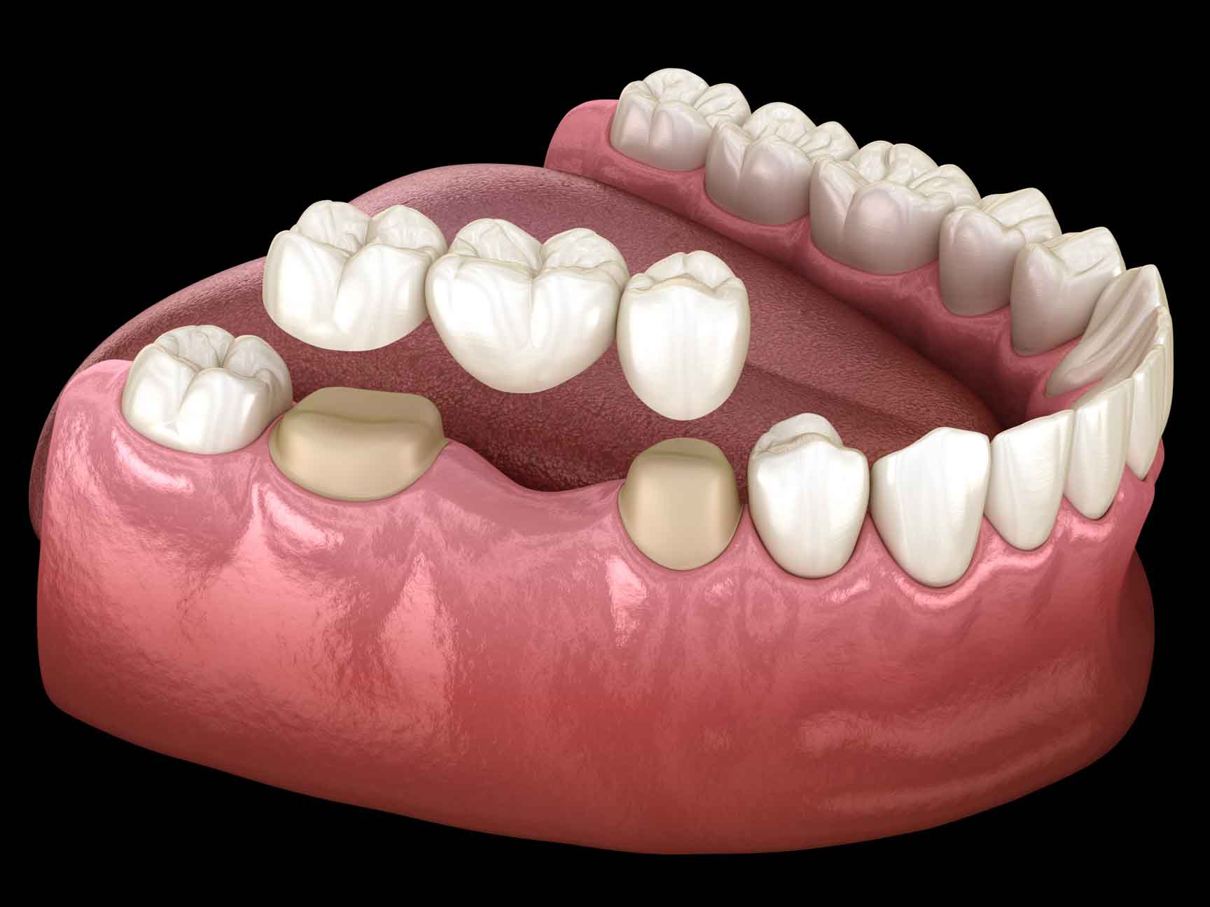 Dental Bridges - princetonsmile.com